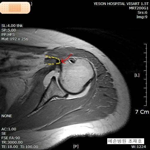 회전근개 파열견갑하근 파열에서의 관절경적 회전근개 봉합술 및 오구돌기 성형술arthroscopic Rotator Cuff