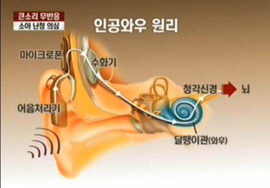 인공와우 이식수술과 재활치료의 중요성 소리귀클리닉 소리와우센터 네이버 블로그
