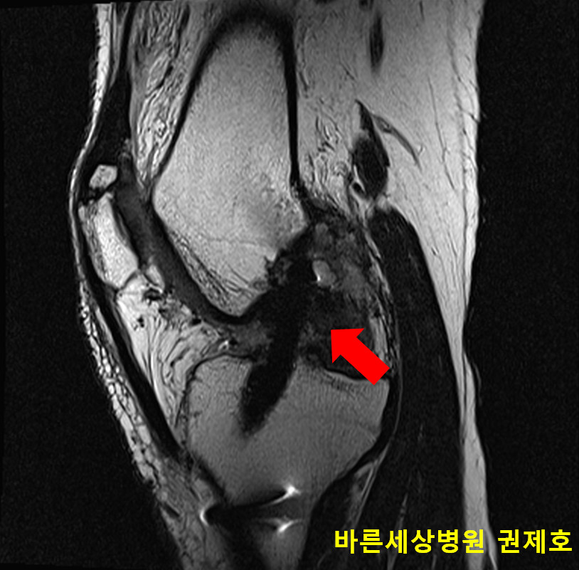 전방십자인대 만성 파열 로 전방십자인대 재건 수술 치료 사례 서울 바른세상병원 권제호 네이버 블로그