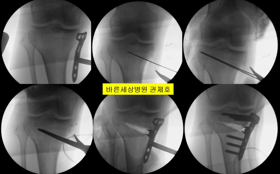 반월상연골판파열로 시행한 무릎관절경 및 근위경골절골술 Cwhto 네이버 블로그