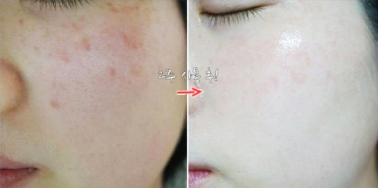 기미주근깨색소침착 제거크림 환한 피부 만들기 리즈벳 스팟 힐링크림 네이버 블로그
