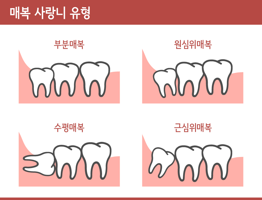 부산치과 사랑니발치 완전매복 또는 매복 사랑니는 발치가 필요한가요 네이버 블로그
