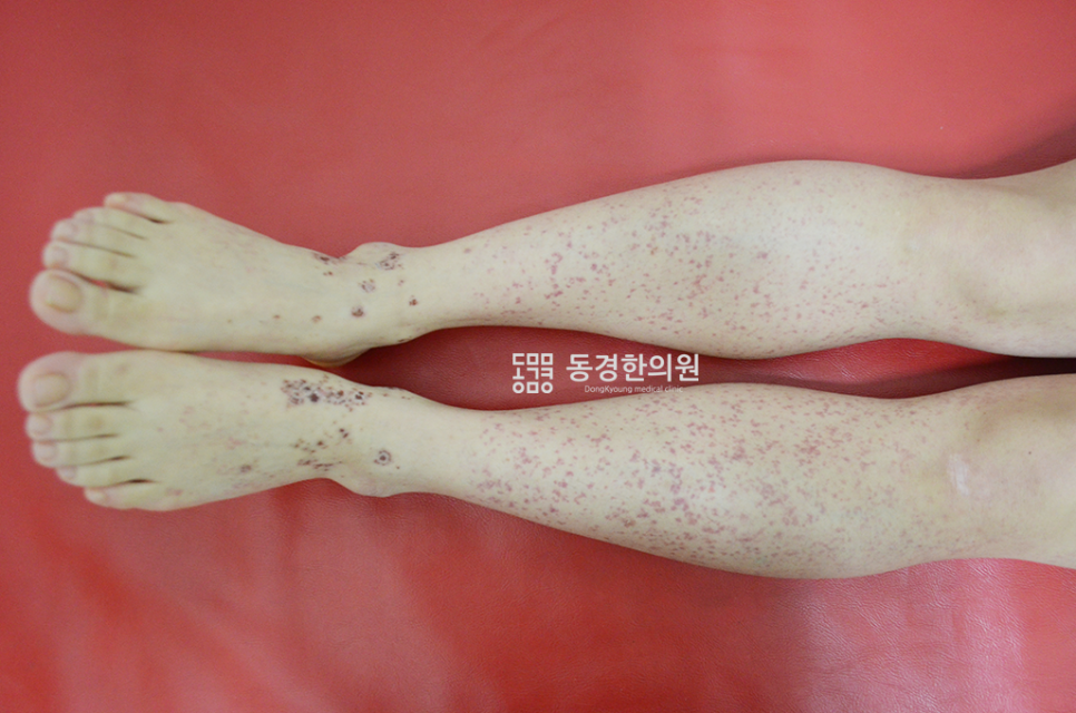 점상출혈로 인한 붉은 반점 자반증일까 네이버 블로그