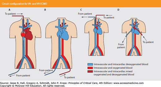 ECMO(에크모) 치료,간호 및 환자관리. Extracorporeal Membrane Oxygenation(VA,VV type) : 네이버 블로그