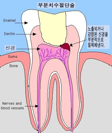 신경치료의 혁명- 부분치수절단술 : 네이버 블로그