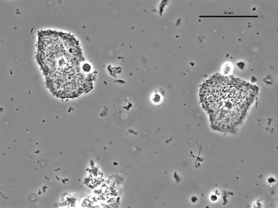 세균성 질염(Bacterial Vaginosis)-2. 진단 : 네이버 블로그