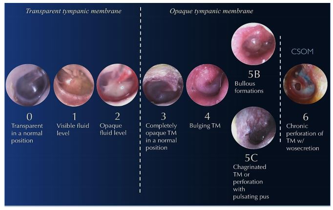 중이염 (Otitis media) : 네이버 블로그