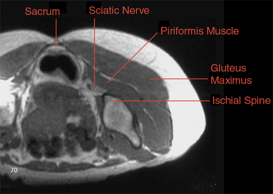 이상근(piriformis muscle)과 통증. : 네이버 블로그