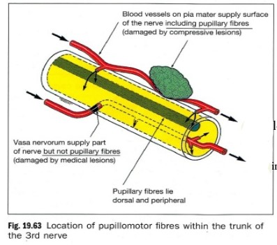 Pupil- sparing 3rd Nerve palsy??? : 네이버 블로그